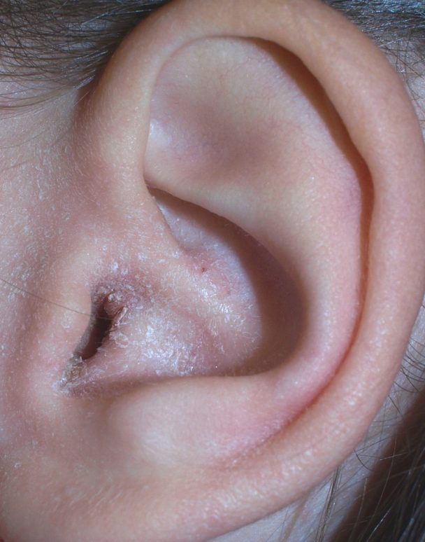 7 Signs Of Health Issues Your Earwax Could Reveal