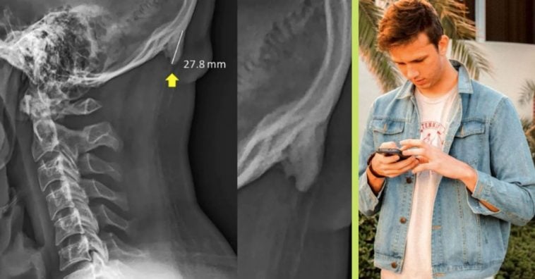 Horns Are Growing On Young People's Skulls From Too Much Phone Use