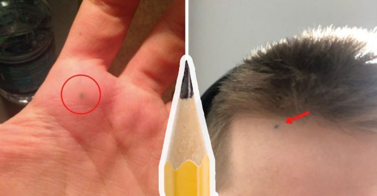 Were You Stabbed By A Pencil And Still Have A Mark? You're Not Alone