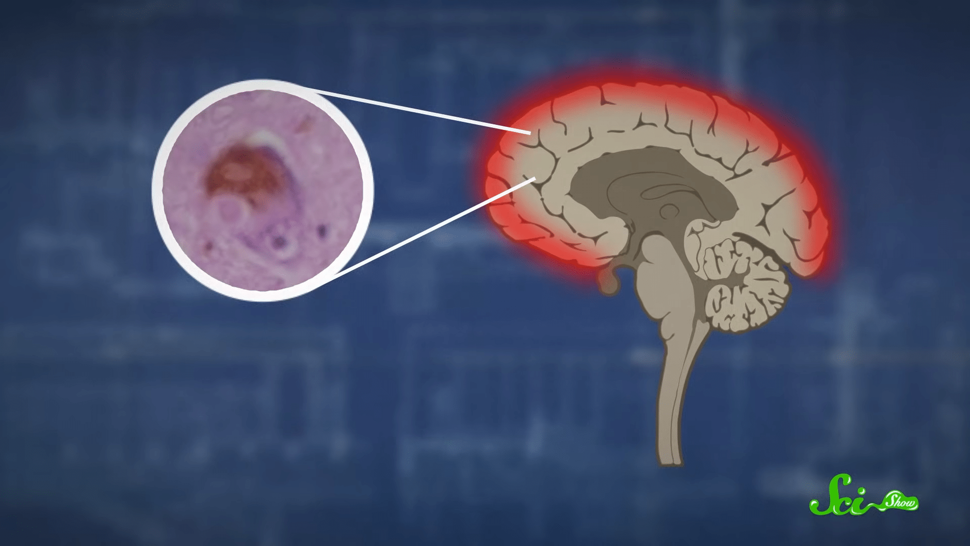 Understanding Lewy Body Dementia, "The Terrorist Inside" Robin Williams ...