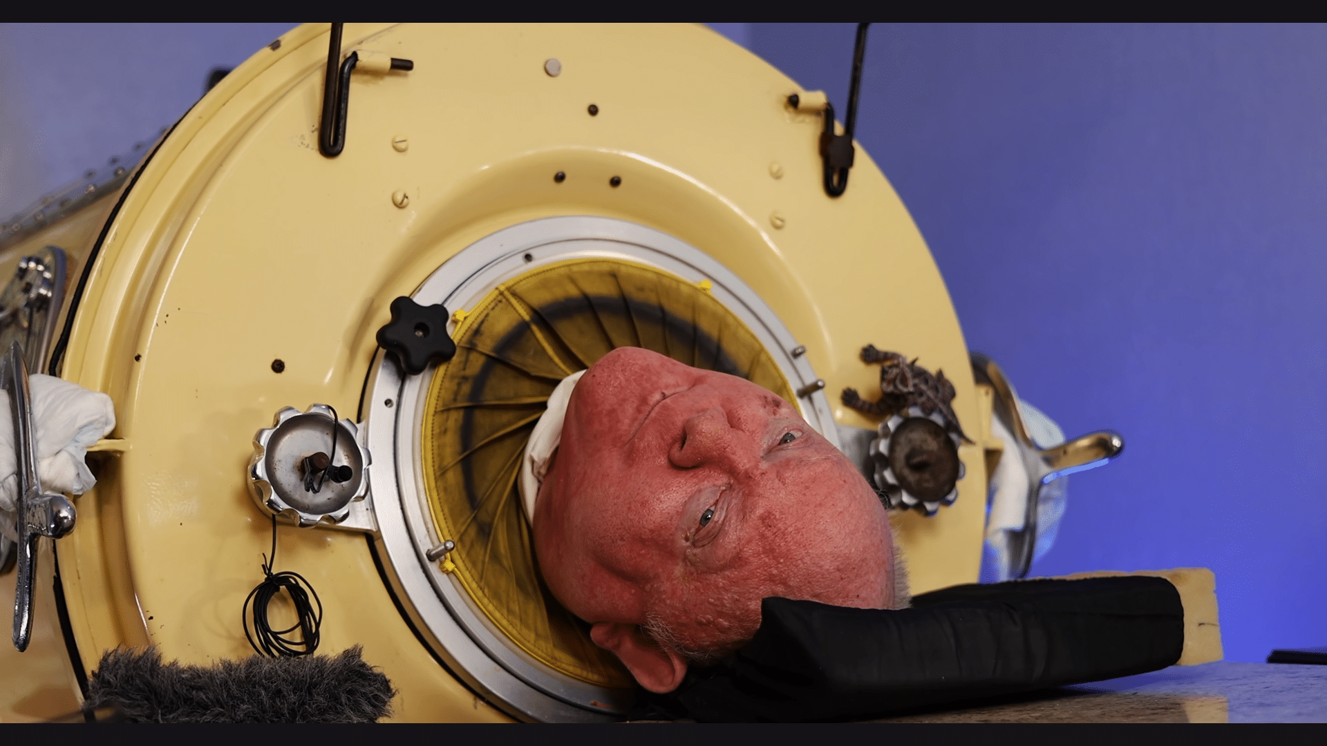 Paul Alexander 'Polio Paul' Who Lived In Iron Lung For 70 Years, Dies At 78